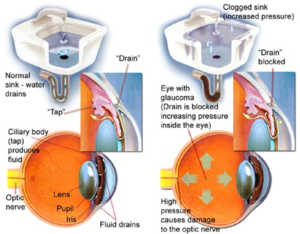 Glaucoma Filtration Surgery - Cloudbreak Pharma, Inc.